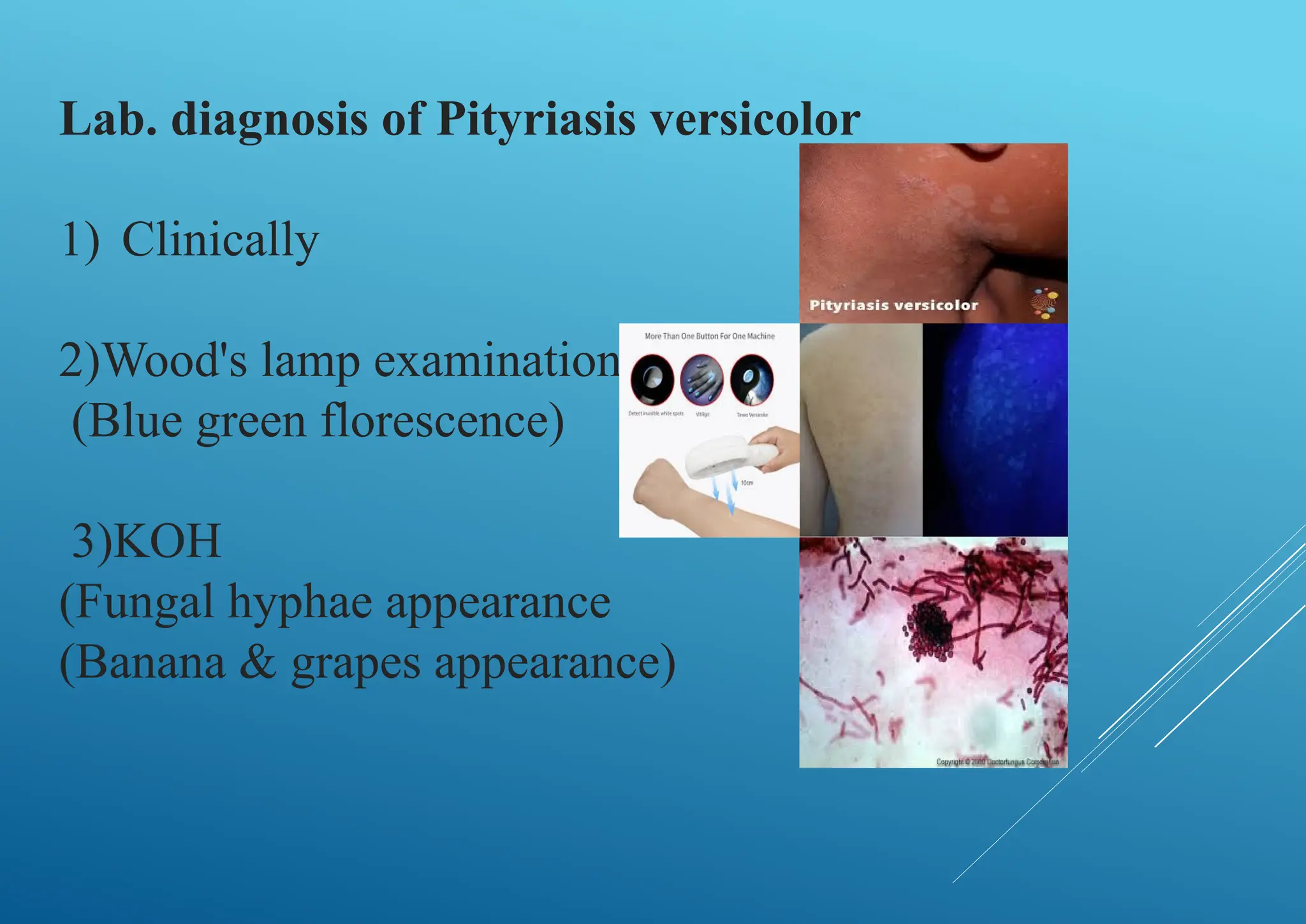 Pityriasis versicolor. For medical student | PPTX