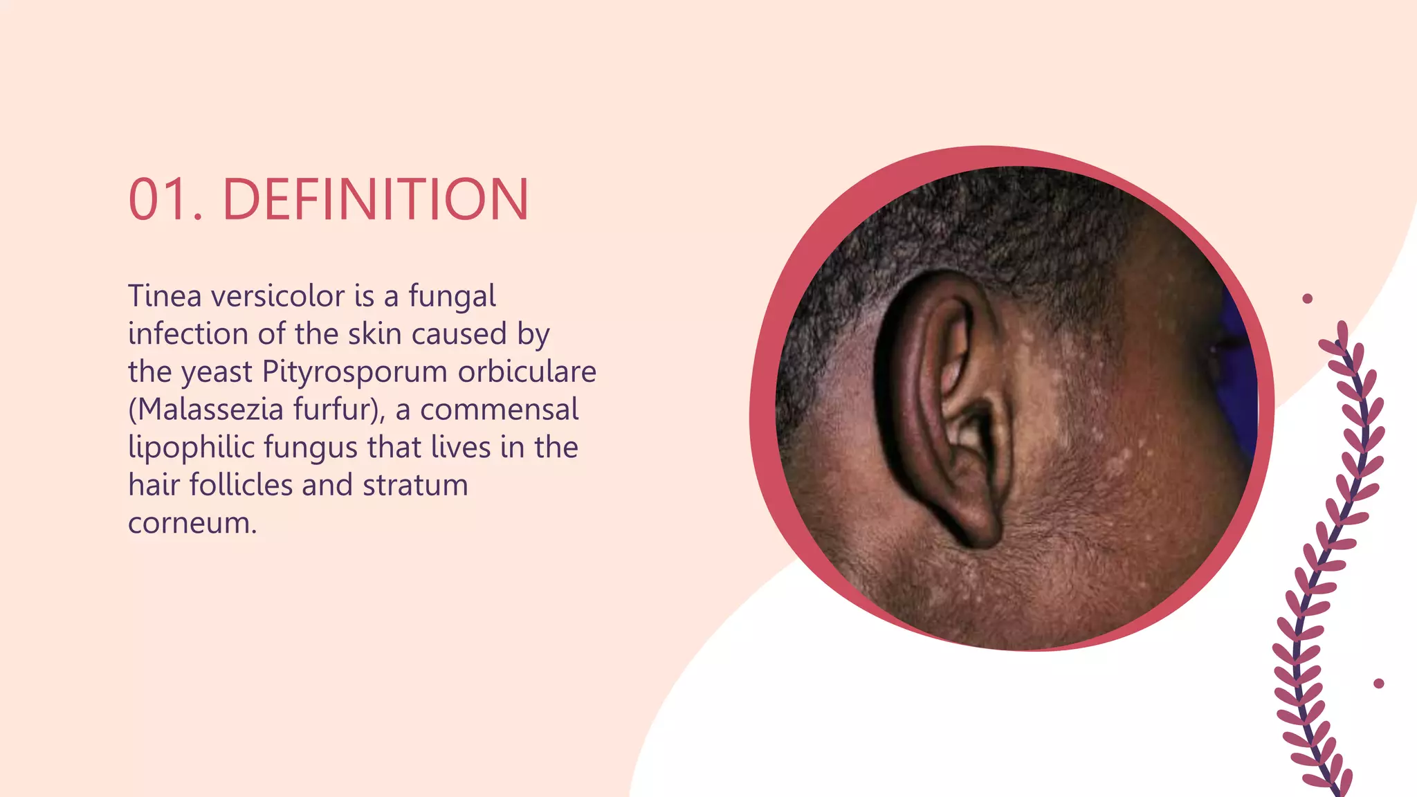 PITYRIASIS VESICULARIS.pptx