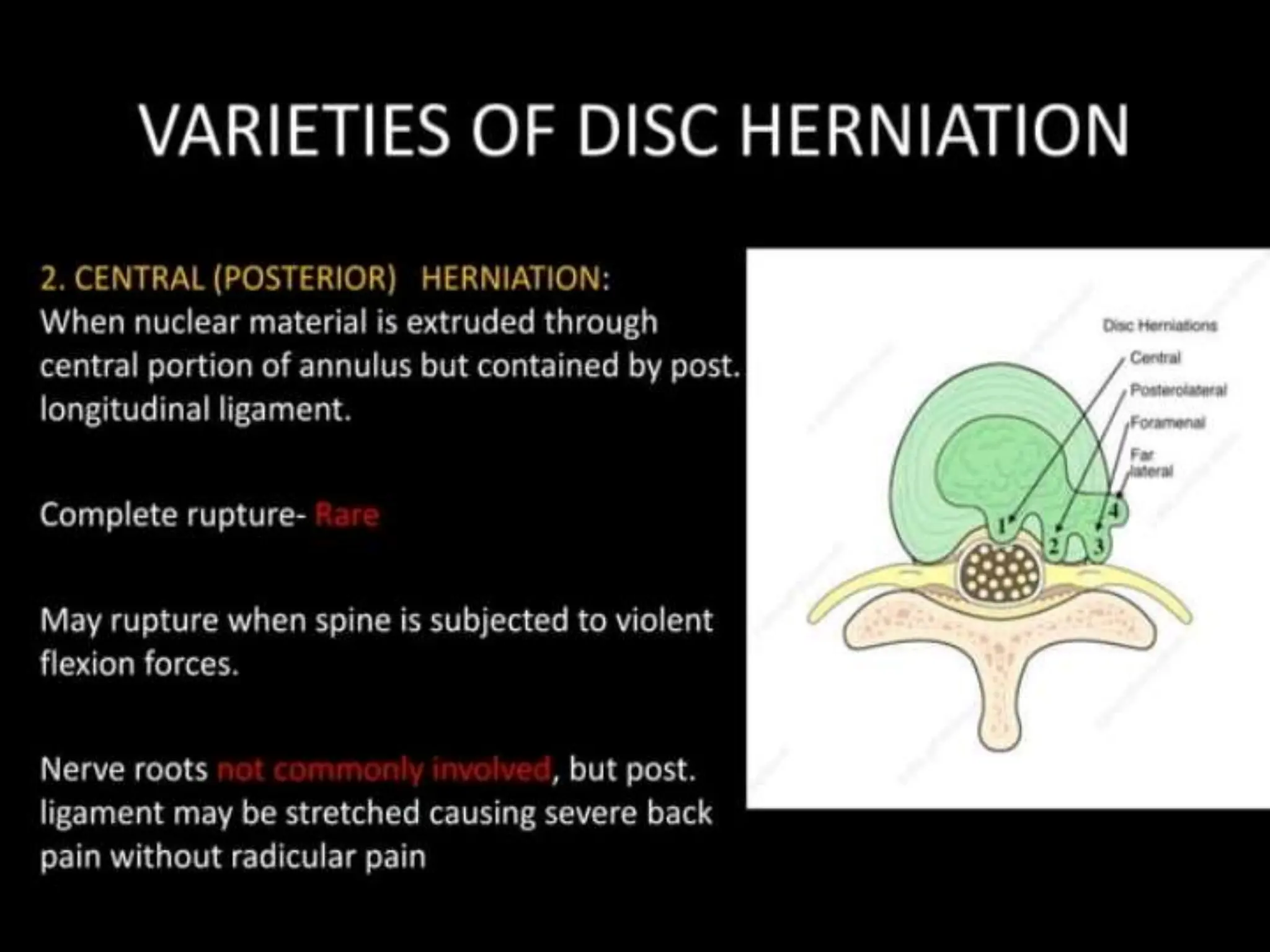 PIVD Prolapsed Intervertebral Disc | PPTX