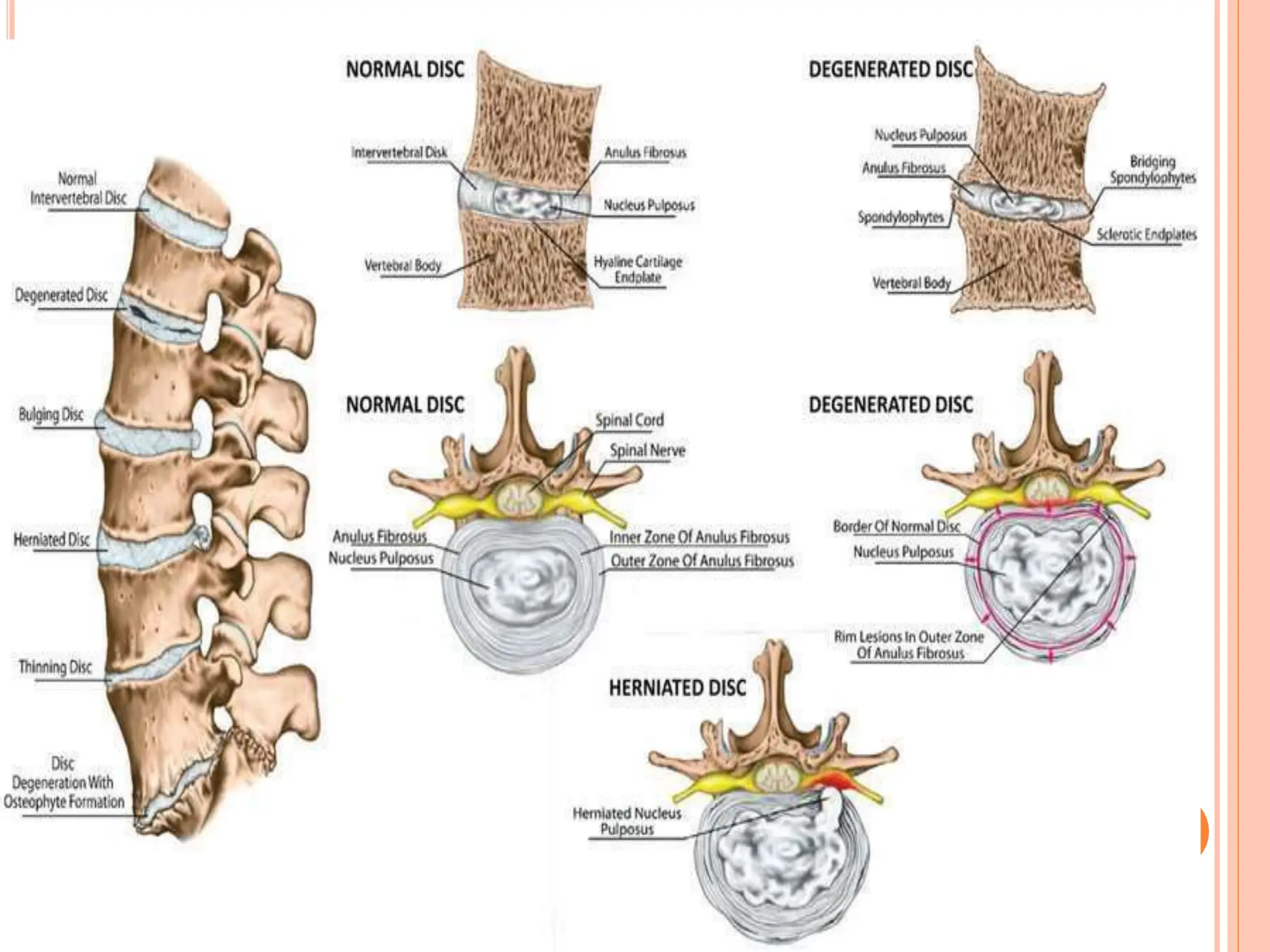 PIVD Prolapsed Intervertebral Disc | PPTX