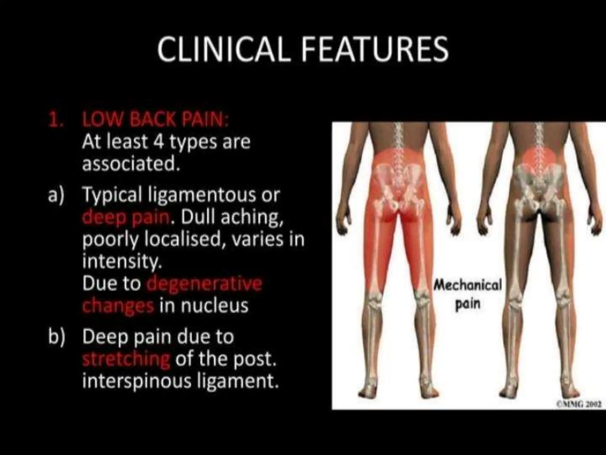 PIVD Prolapsed Intervertebral Disc | PPTX