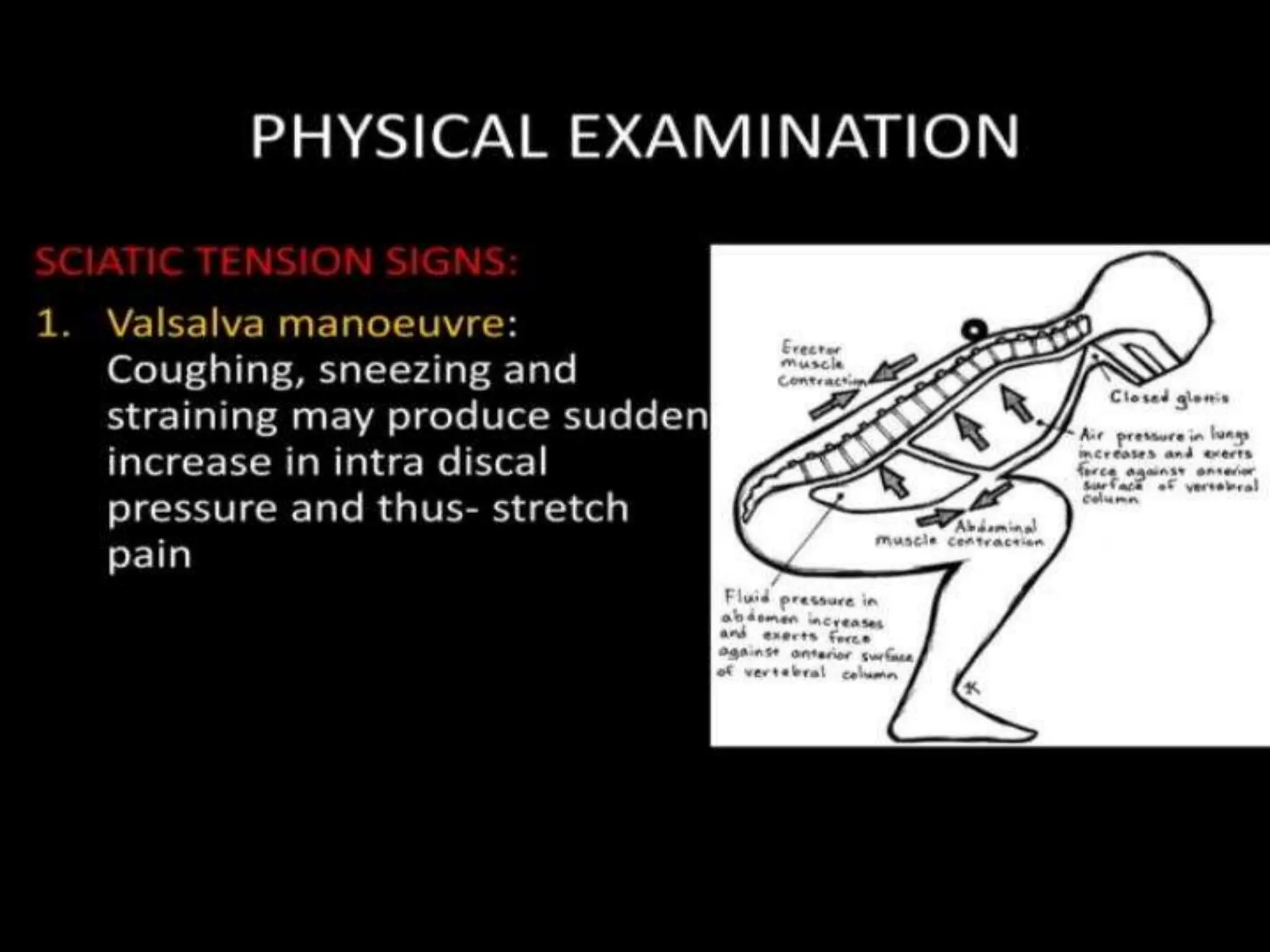 PIVD Prolapsed Intervertebral Disc | PPTX