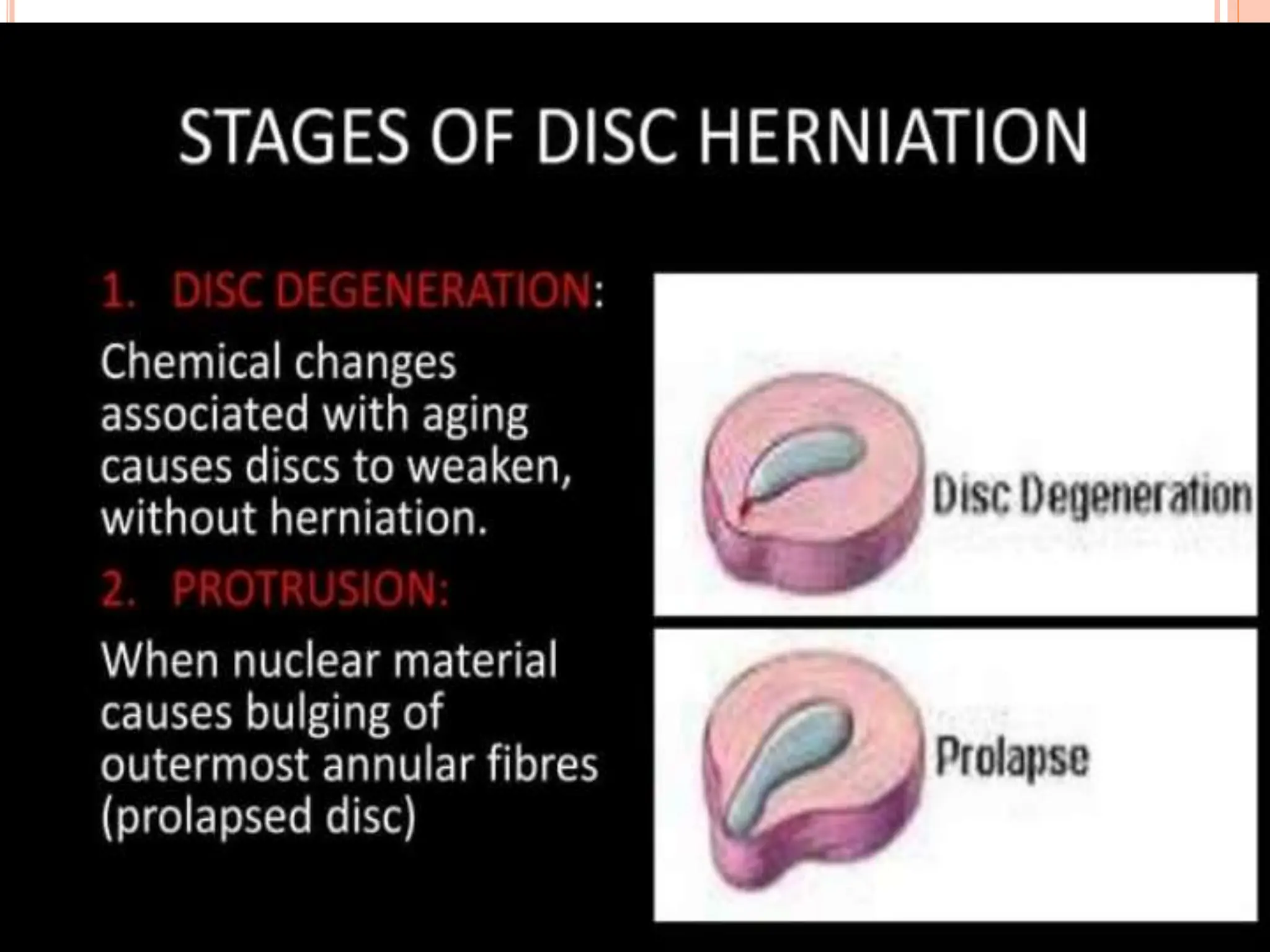 PIVD Prolapsed Intervertebral Disc | PPTX