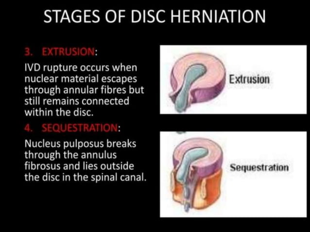 PIVD Prolapsed Intervertebral Disc | PPTX