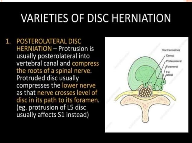 PIVD Prolapsed Intervertebral Disc | PPTX