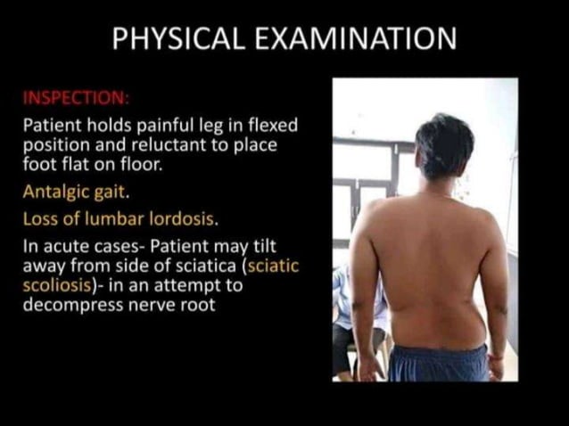 PIVD Prolapsed Intervertebral Disc | PPTX