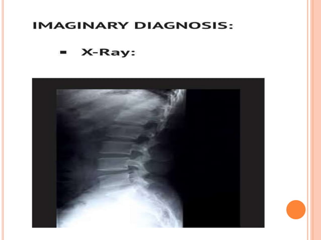 PIVD Prolapsed Intervertebral Disc | PPTX