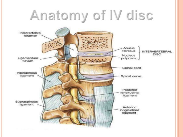 PIVD Prolapsed Intervertebral Disc | PPT | Free Download