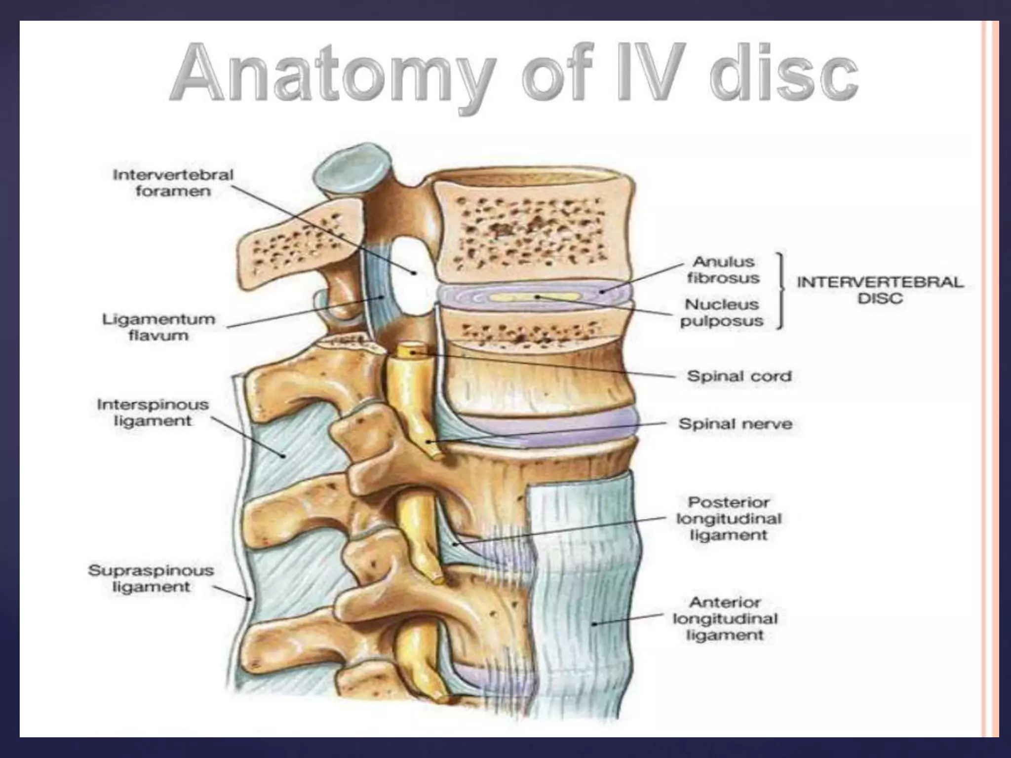 INTERVERTEBRAL DISC PROLAPSE (PIVD) | PPTX