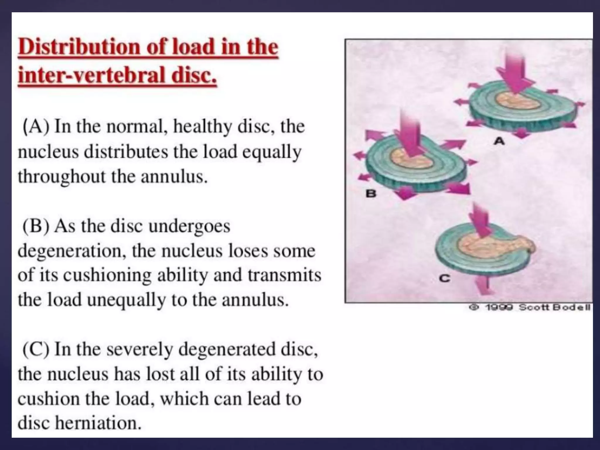 INTERVERTEBRAL DISC PROLAPSE (PIVD) | PPTX