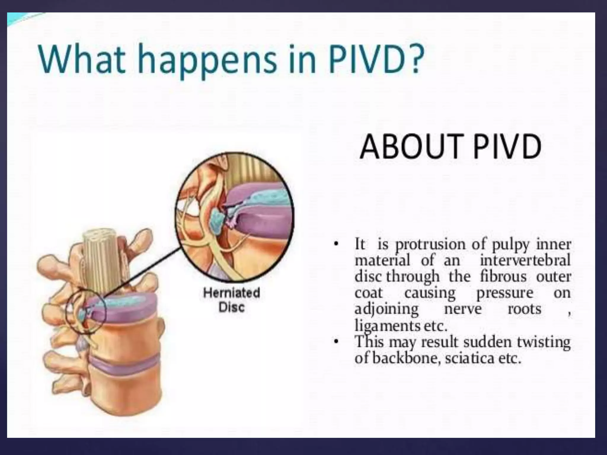 INTERVERTEBRAL DISC PROLAPSE (PIVD) | PPTX