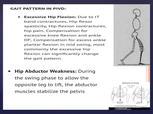 INTERVERTEBRAL DISC PROLAPSE (PIVD) | PPTX