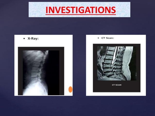 INTERVERTEBRAL DISC PROLAPSE (PIVD) | PPTX