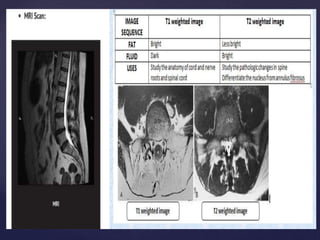INTERVERTEBRAL DISC PROLAPSE (PIVD) | PPTX