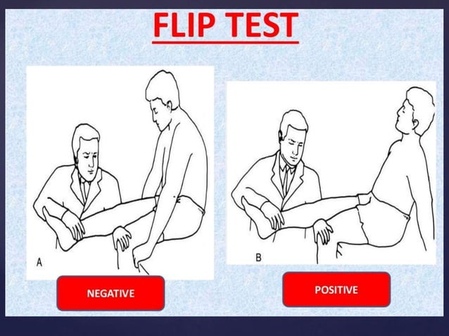 INTERVERTEBRAL DISC PROLAPSE (PIVD) | PPTX