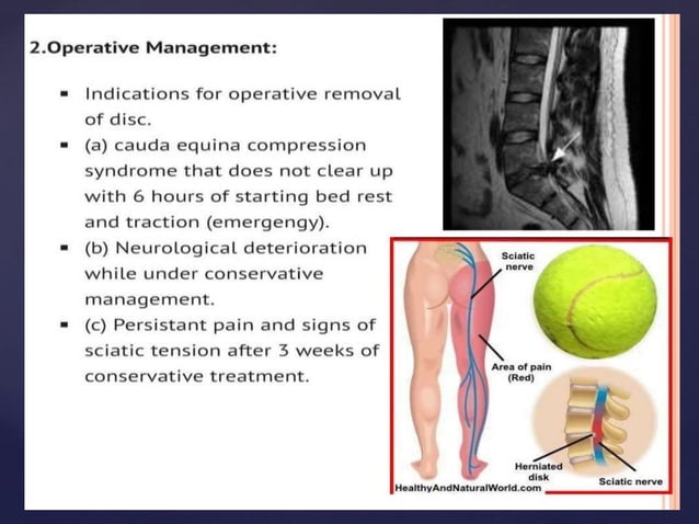 INTERVERTEBRAL DISC PROLAPSE (PIVD) | PPTX