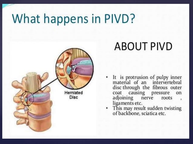 INTERVERTEBRAL DISC PROLAPSE (PIVD) | PPTX