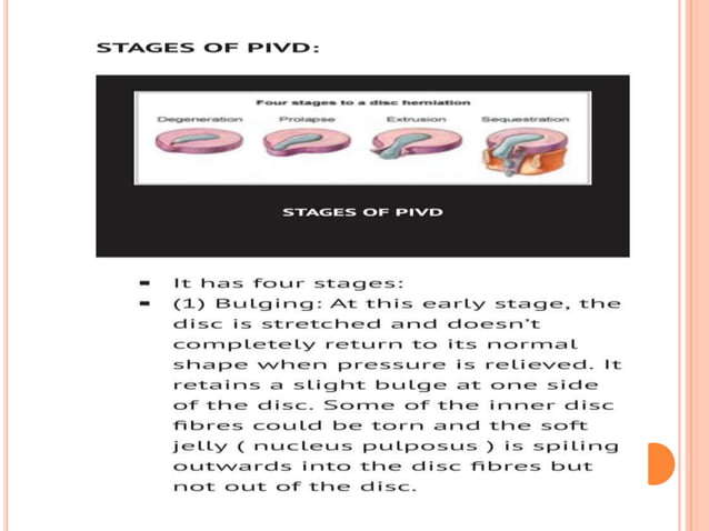 Pivd ppt | PPTX | Death, Injury, or Military Conflict | Sensitive Topics