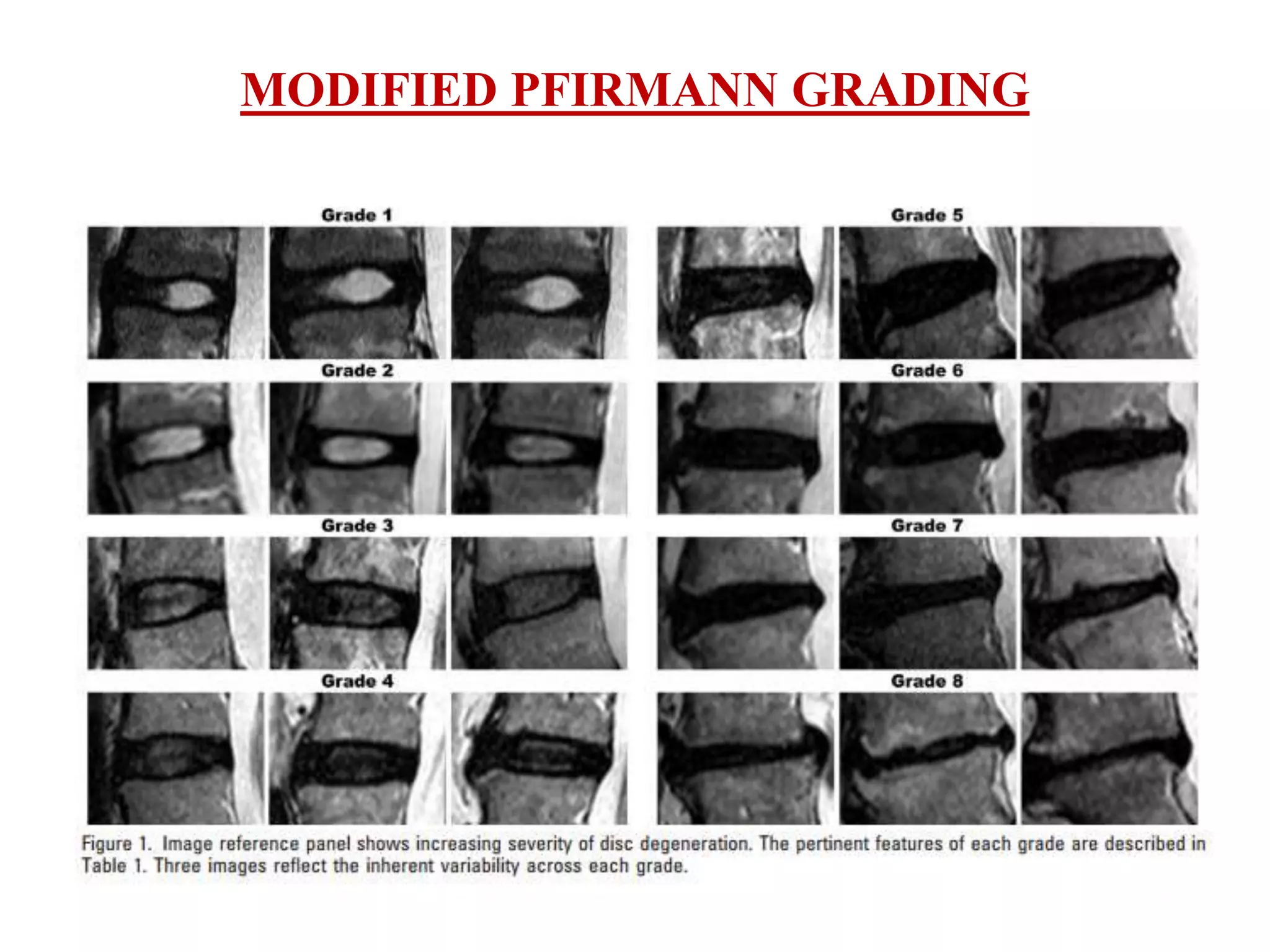 INTERVERTEBRAL DISC ANATOMY AND PIVD OF LUMBAR SPINE AND ITS MANAGEMENT ...
