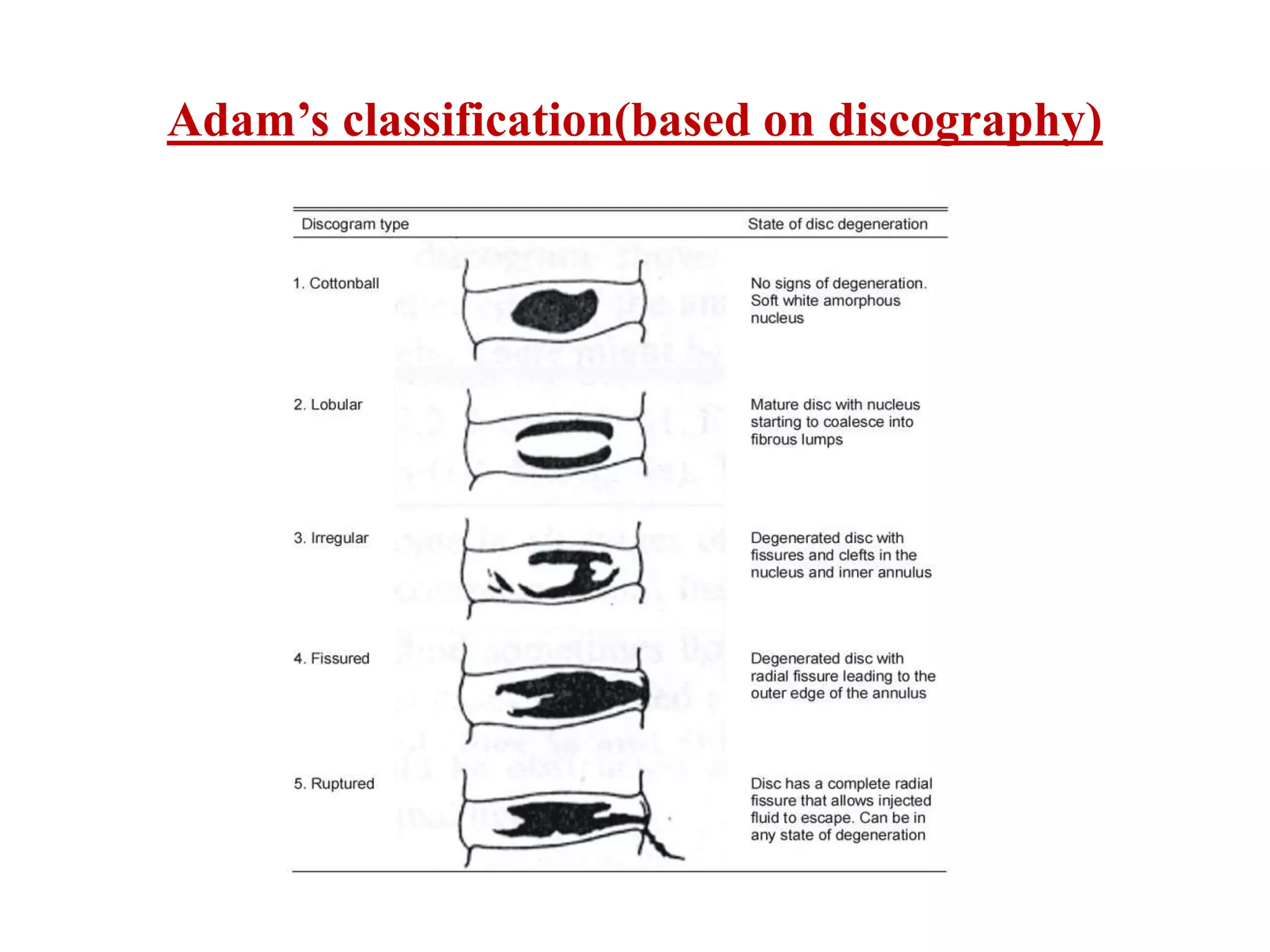 INTERVERTEBRAL DISC ANATOMY AND PIVD OF LUMBAR SPINE AND ITS MANAGEMENT ...