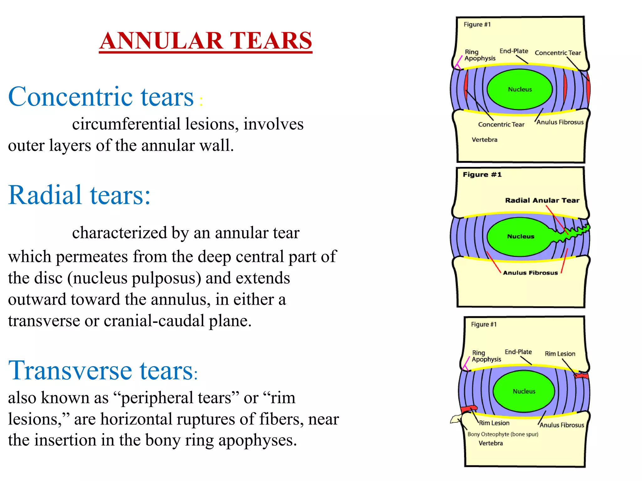 INTERVERTEBRAL DISC ANATOMY AND PIVD OF LUMBAR SPINE AND ITS MANAGEMENT ...