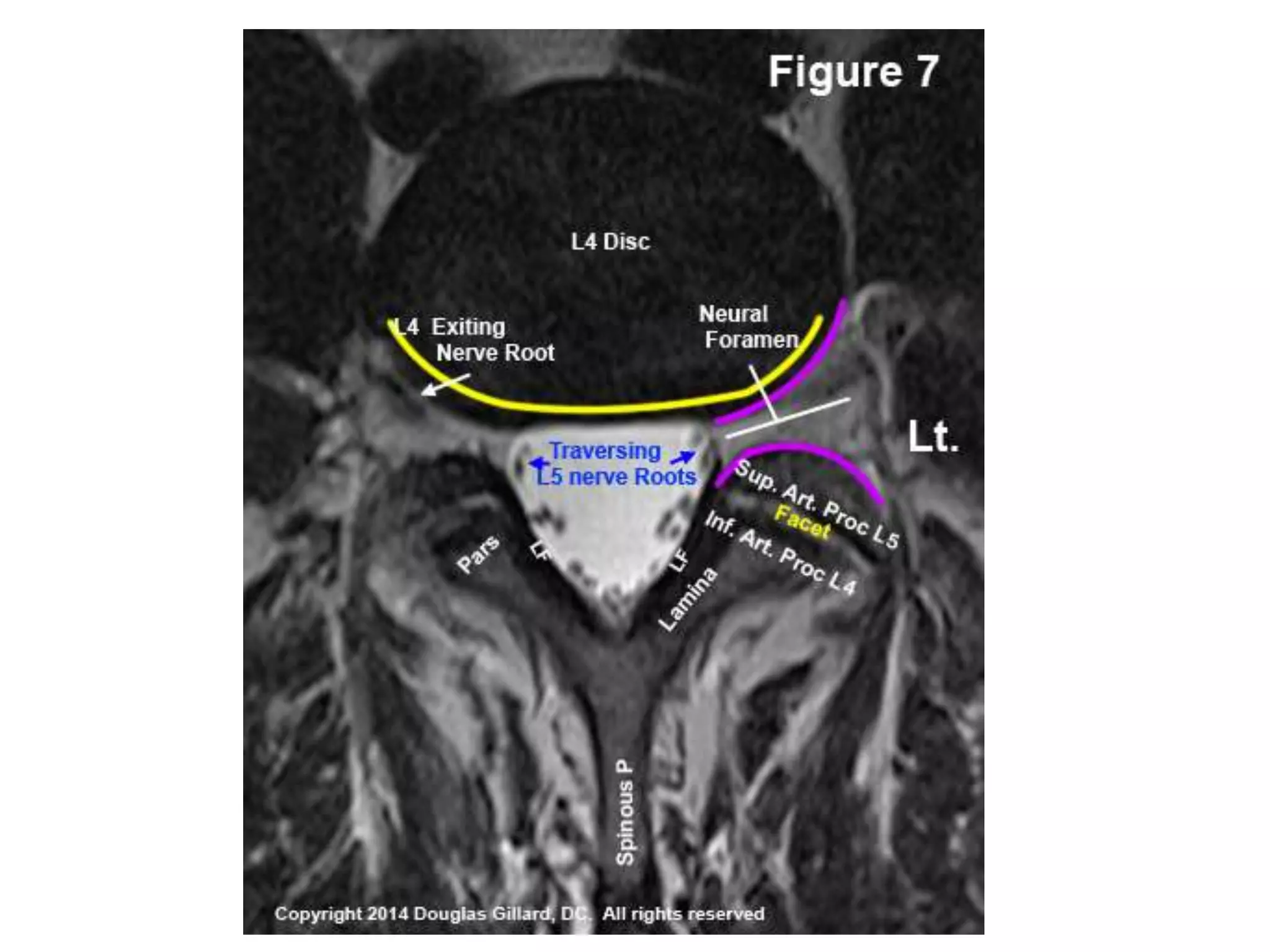INTERVERTEBRAL DISC ANATOMY AND PIVD OF LUMBAR SPINE AND ITS MANAGEMENT ...
