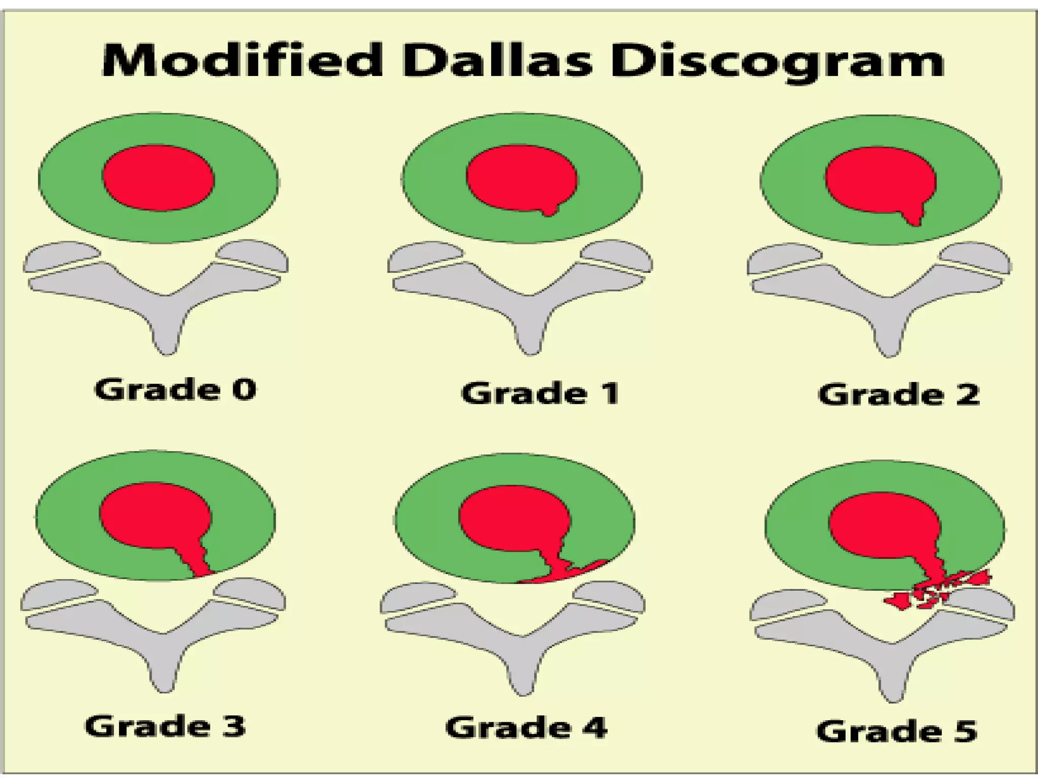INTERVERTEBRAL DISC ANATOMY AND PIVD OF LUMBAR SPINE AND ITS MANAGEMENT ...