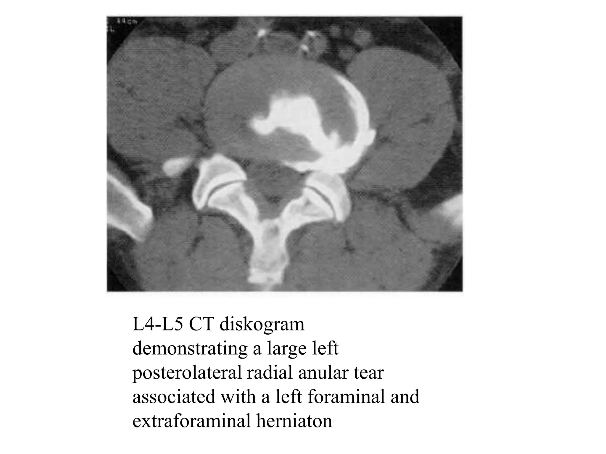 INTERVERTEBRAL DISC ANATOMY AND PIVD OF LUMBAR SPINE AND ITS MANAGEMENT ...