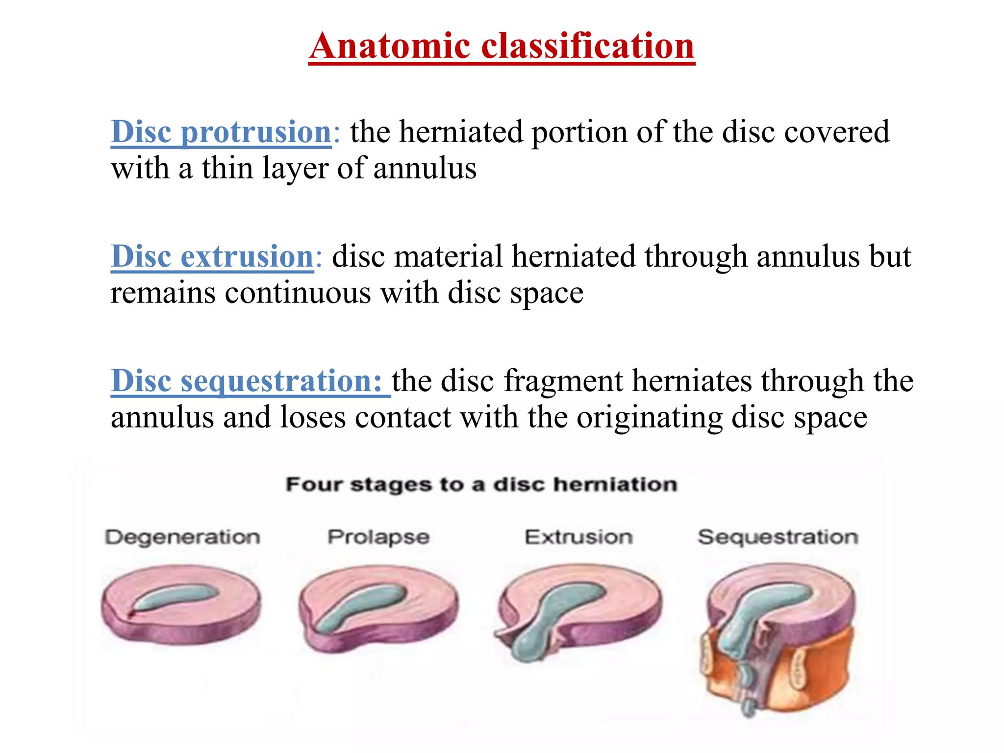 INTERVERTEBRAL DISC ANATOMY AND PIVD OF LUMBAR SPINE AND ITS MANAGEMENT ...