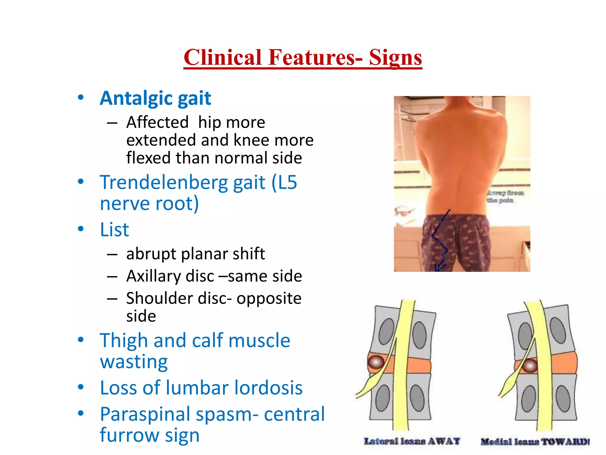 INTERVERTEBRAL DISC ANATOMY AND PIVD OF LUMBAR SPINE AND ITS MANAGEMENT ...