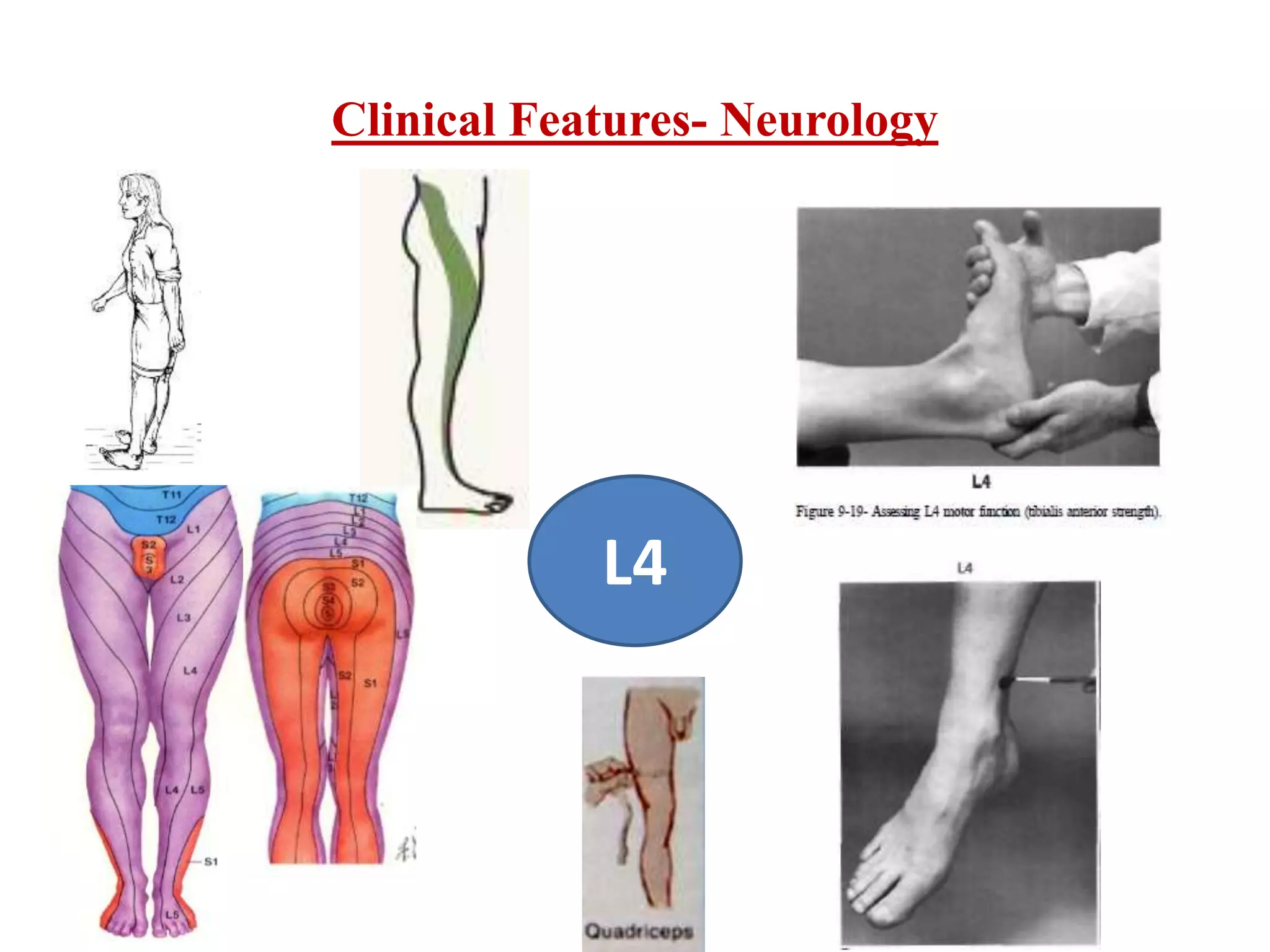 INTERVERTEBRAL DISC ANATOMY AND PIVD OF LUMBAR SPINE AND ITS MANAGEMENT ...