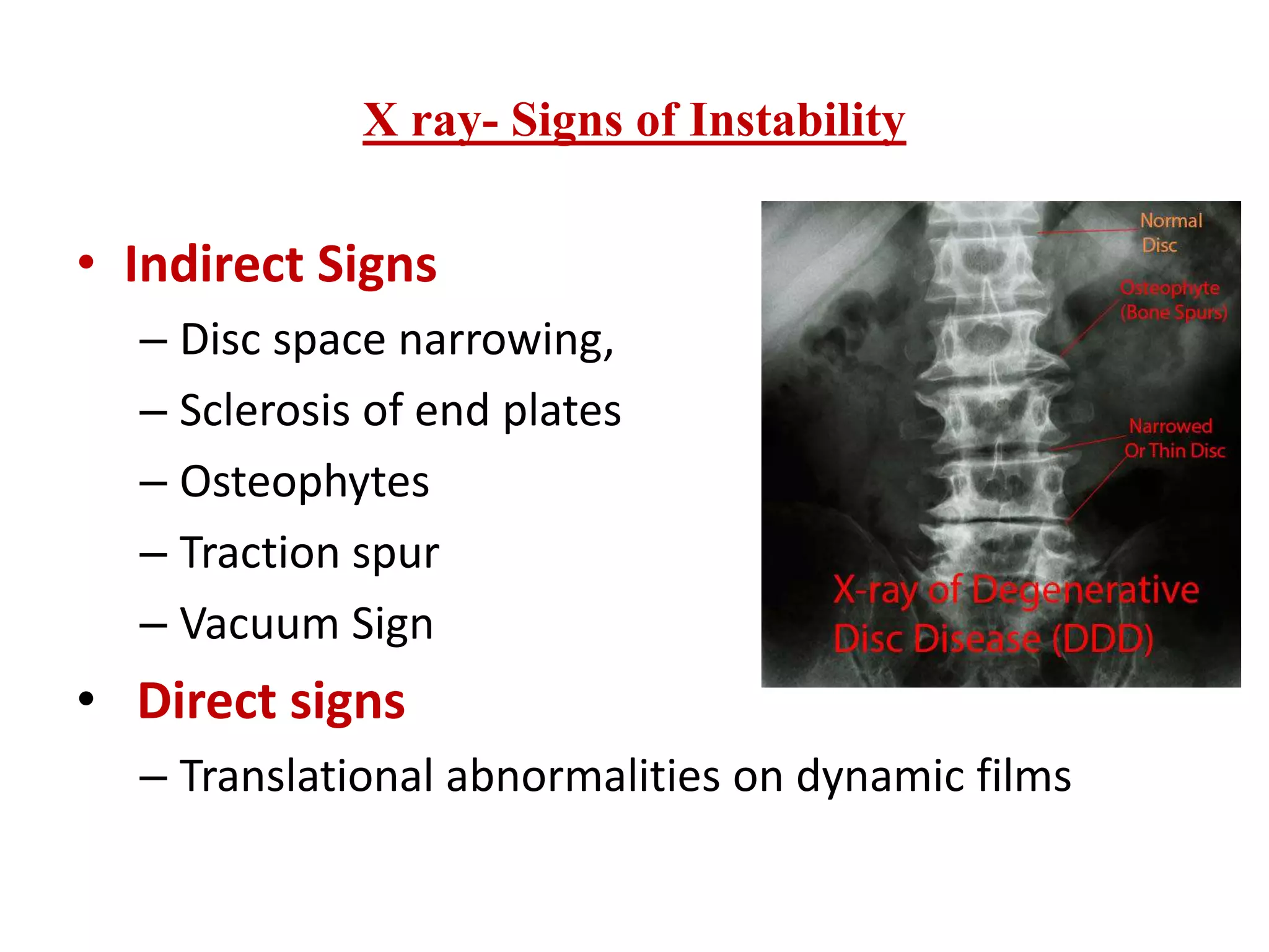 INTERVERTEBRAL DISC ANATOMY AND PIVD OF LUMBAR SPINE AND ITS MANAGEMENT ...