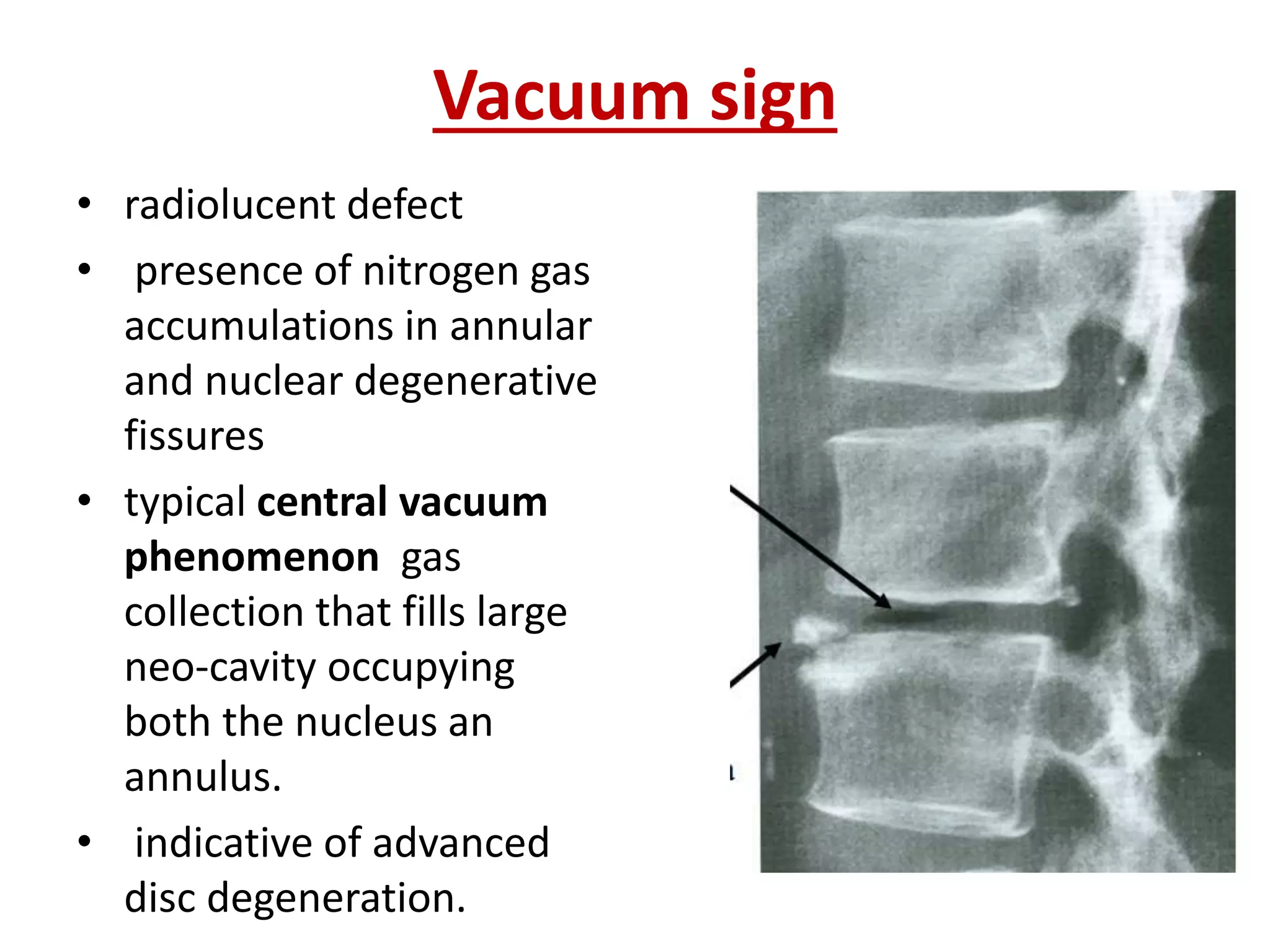 INTERVERTEBRAL DISC ANATOMY AND PIVD OF LUMBAR SPINE AND ITS MANAGEMENT ...