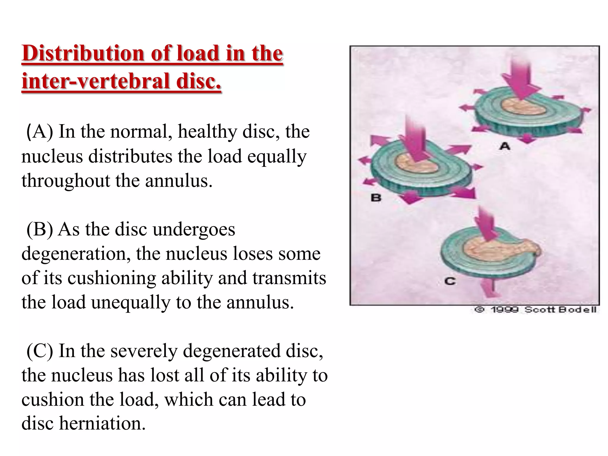 INTERVERTEBRAL DISC ANATOMY AND PIVD OF LUMBAR SPINE AND ITS MANAGEMENT ...