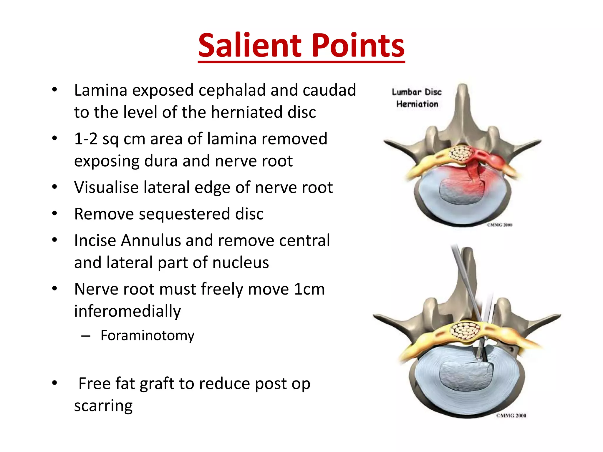 INTERVERTEBRAL DISC ANATOMY AND PIVD OF LUMBAR SPINE AND ITS MANAGEMENT ...