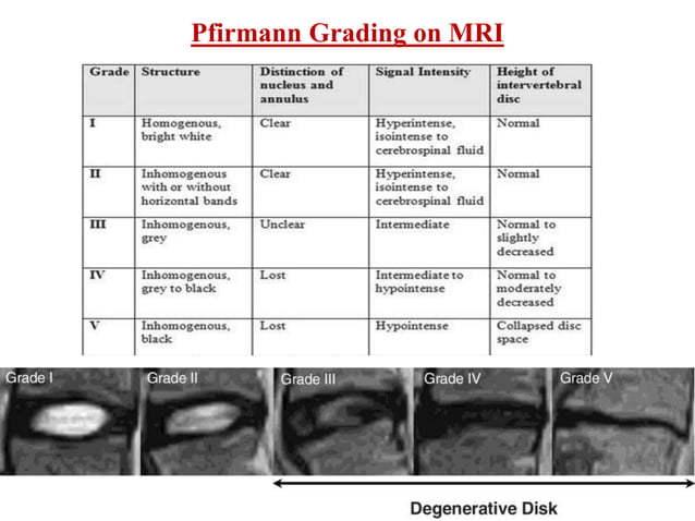 INTERVERTEBRAL DISC ANATOMY AND PIVD OF LUMBAR SPINE AND ITS MANAGEMENT ...
