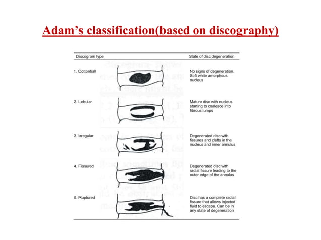 INTERVERTEBRAL DISC ANATOMY AND PIVD OF LUMBAR SPINE AND ITS MANAGEMENT ...