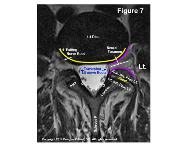 INTERVERTEBRAL DISC ANATOMY AND PIVD OF LUMBAR SPINE AND ITS MANAGEMENT ...