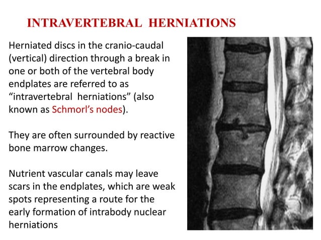 INTERVERTEBRAL DISC ANATOMY AND PIVD OF LUMBAR SPINE AND ITS MANAGEMENT ...