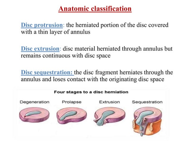 INTERVERTEBRAL DISC ANATOMY AND PIVD OF LUMBAR SPINE AND ITS MANAGEMENT ...