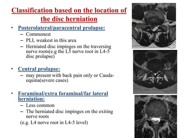 INTERVERTEBRAL DISC ANATOMY AND PIVD OF LUMBAR SPINE AND ITS MANAGEMENT ...
