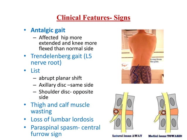INTERVERTEBRAL DISC ANATOMY AND PIVD OF LUMBAR SPINE AND ITS MANAGEMENT ...