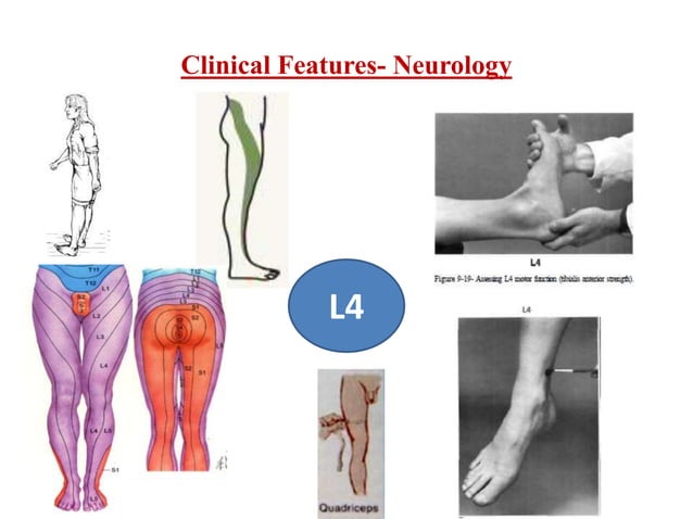 INTERVERTEBRAL DISC ANATOMY AND PIVD OF LUMBAR SPINE AND ITS MANAGEMENT ...