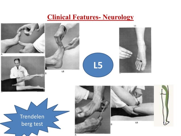 INTERVERTEBRAL DISC ANATOMY AND PIVD OF LUMBAR SPINE AND ITS MANAGEMENT ...