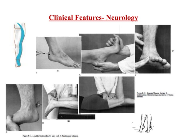 INTERVERTEBRAL DISC ANATOMY AND PIVD OF LUMBAR SPINE AND ITS MANAGEMENT ...