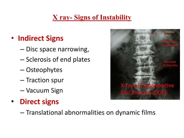 INTERVERTEBRAL DISC ANATOMY AND PIVD OF LUMBAR SPINE AND ITS MANAGEMENT ...