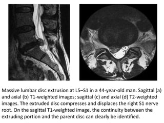INTERVERTEBRAL DISC ANATOMY AND PIVD OF LUMBAR SPINE AND ITS MANAGEMENT ...