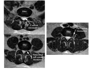 INTERVERTEBRAL DISC ANATOMY AND PIVD OF LUMBAR SPINE AND ITS MANAGEMENT ...