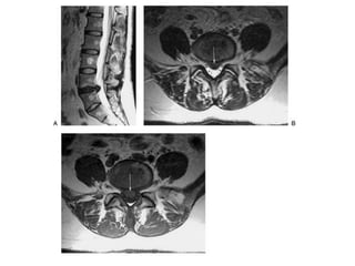 INTERVERTEBRAL DISC ANATOMY AND PIVD OF LUMBAR SPINE AND ITS MANAGEMENT ...