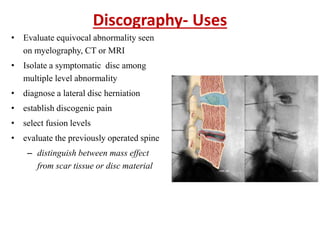 INTERVERTEBRAL DISC ANATOMY AND PIVD OF LUMBAR SPINE AND ITS MANAGEMENT ...